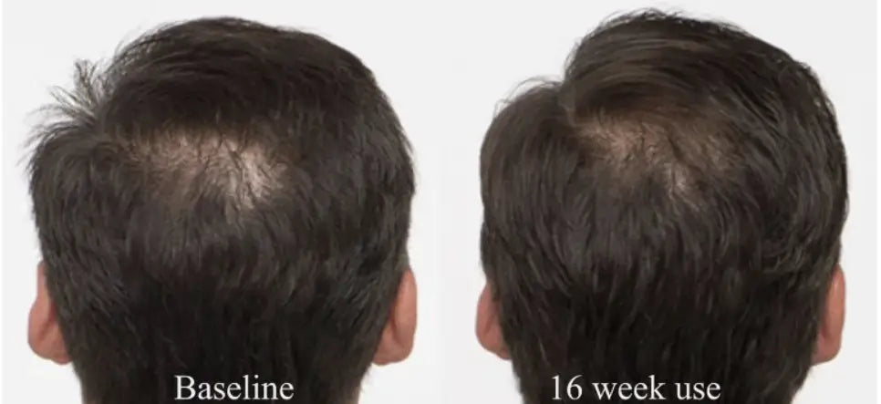 MSM Curing Baldness? – MISMO Body Care